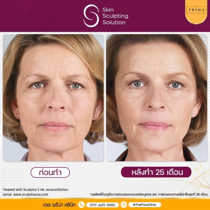 Skin Sculpting Solution #1 ชลบุรี เทคนิคเฉพาะรับรองจากบริษัท