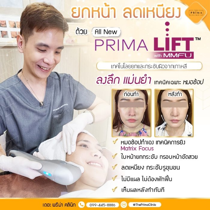 HIFU ไฮฟูชลบุรี ยังต้องแพ้ Prima Lift by Ultraformer III