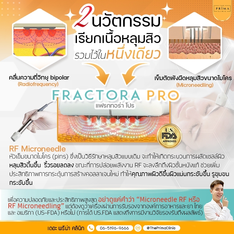 Fractora Pro นวัตกรรมรักษาหลุมสิวอย่างตรงจุด